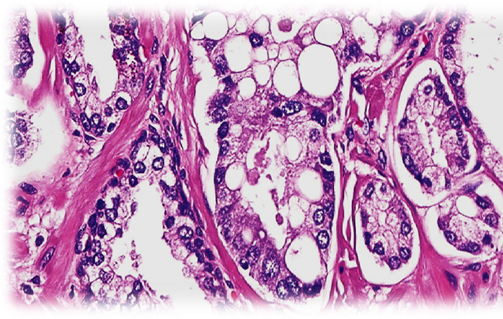 Prostate Cancer Grading. A Decade After the 2005 Modified Gleason ...