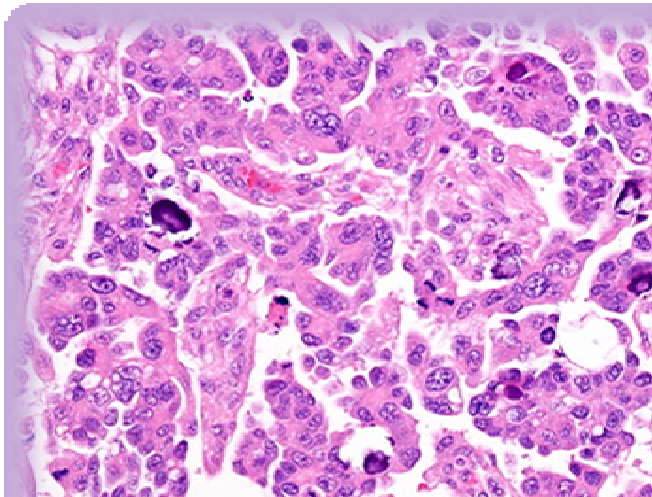 The fallopian tube as the origin of non-uterine pelvic high-grade ...